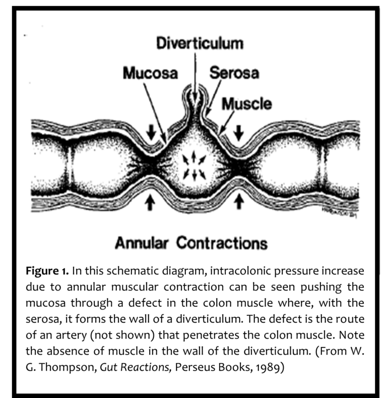 Diverticulosis And Diverticulitis - IFFGD